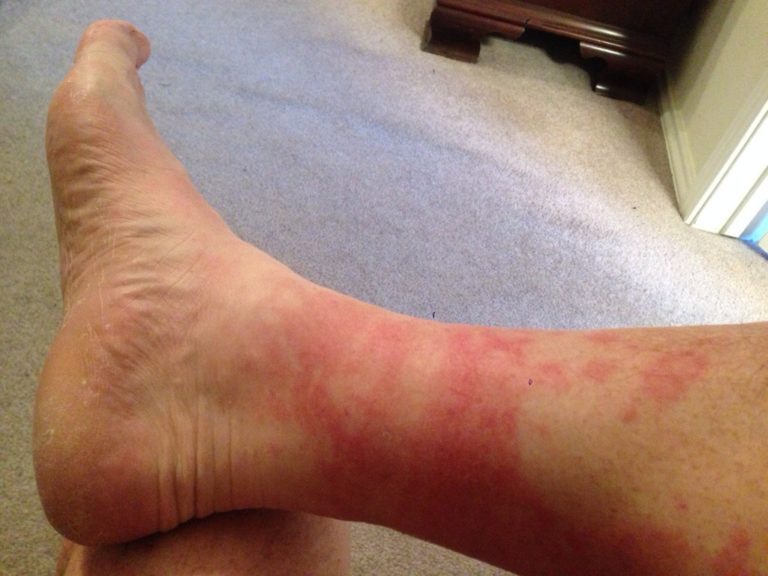 Golfer's/Hiker's/Runner's/Disney Rash: What It Is & How To Treat ...
